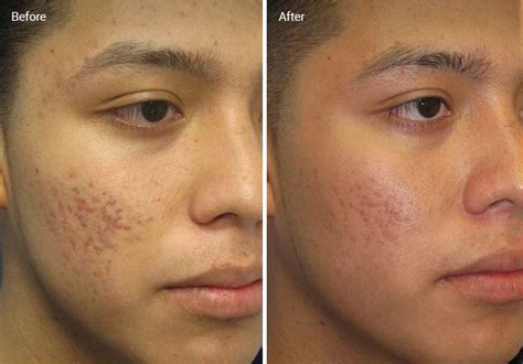 Laser Skin Resurfacing For Acne Scars Efficacy Before And Afters Cost
