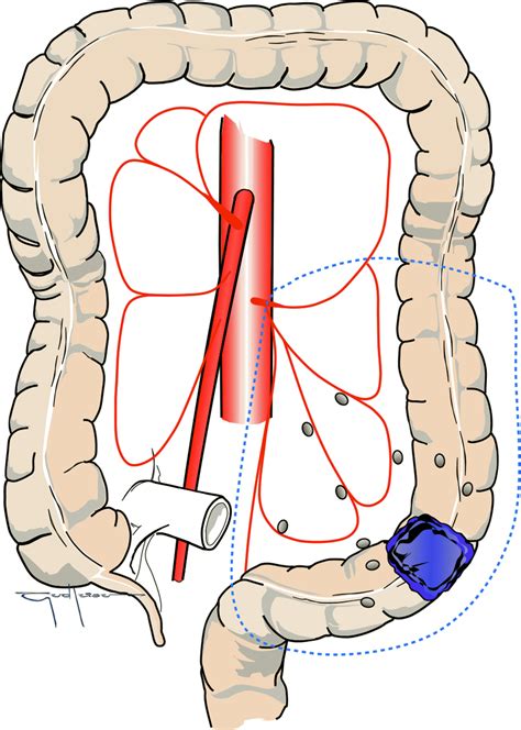 Sigmoid Resection From Weber K Perrakis A Hohenberger W Standard