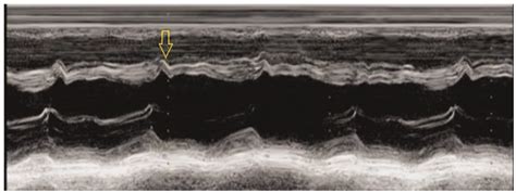 M Mode Echocardiography Of A Patient With Cp An Obvious V Shaped Cut
