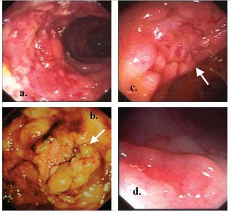 A A Circumferential Ulcer In Terminal Ileum B Ulcerated And Download Scientific Diagram