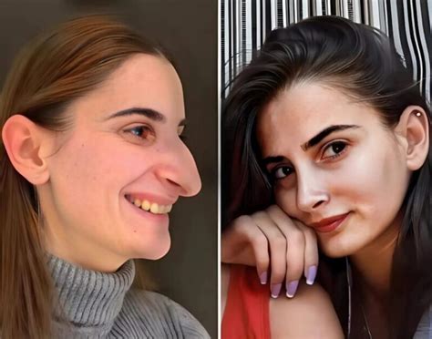 A Girl With An Unusual Nose Underwent Plastic Surgery Heres What She