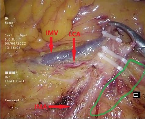 A novel technique for NO.253 lymph node dissection and left colic artery preservation to avoid ...