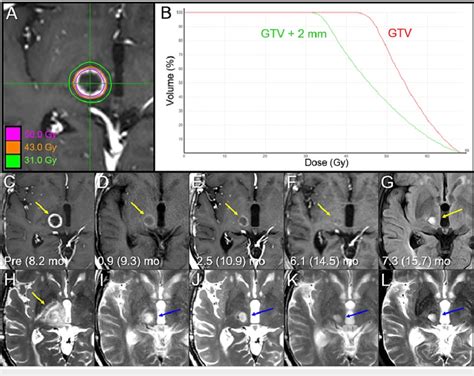 Dose Distribution Dose Volume Histograms And Magnetic Resonance Download Scientific Diagram