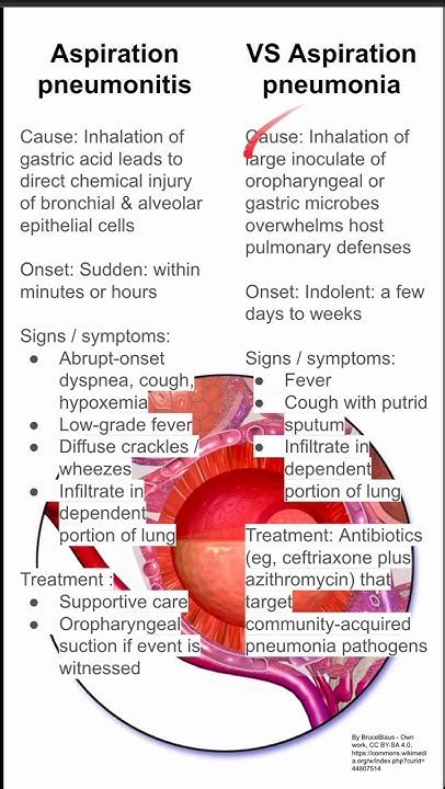 Aspiration Pneumonitis Vs Aspiration Pneumonia Youtube