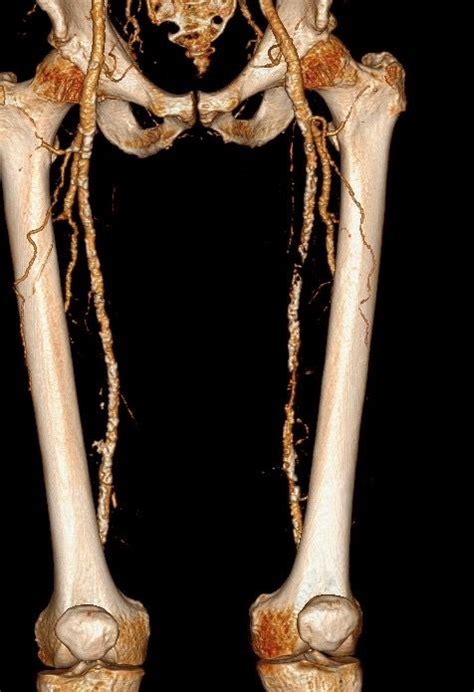 Ahmed Algharib On Linkedin A Challenging Case Involving The Treatment