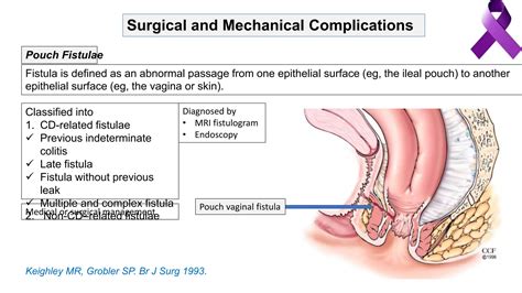 Ulcerative Colitis Complications Management Pptx