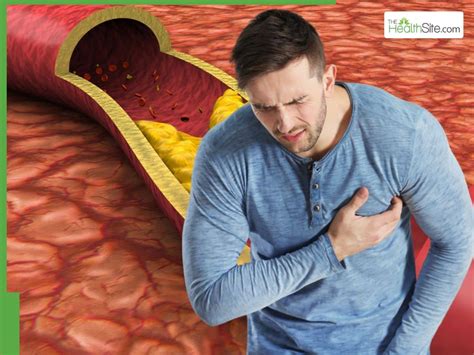 7 Superfoods To Prevent Plaque Formation In Arteries And Lower Ldl