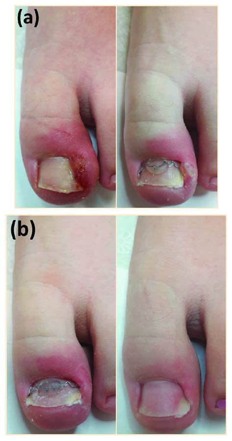 Clinical Picture Of The Nail Apparatus On A 13 Year Old Girl The 4a