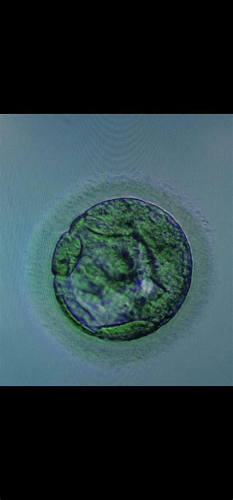 FelicitĂri Dr Mircea Muncean A Mai Reușit O PremierĂ și O PerformanȚĂ Gazeta De Nord Vest