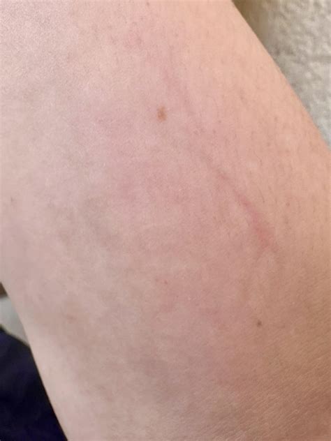 Patch Rash Eruption Rdiagnoseme