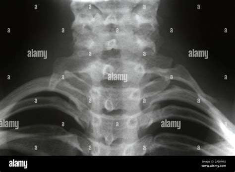 Model Released Cervical Ribs X Ray Of The Neck Of A 13 Year Old Girl
