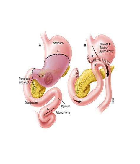 Partial Gastrectomy