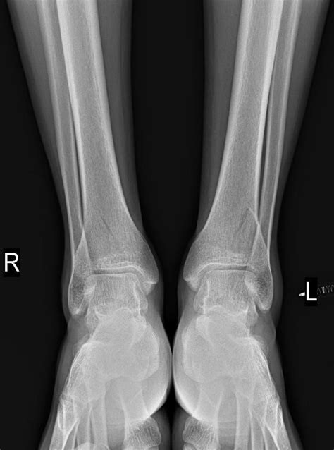 Radiopaedia Case Pilon Fracture Bilateral Id 52423 Study 58335 Nc