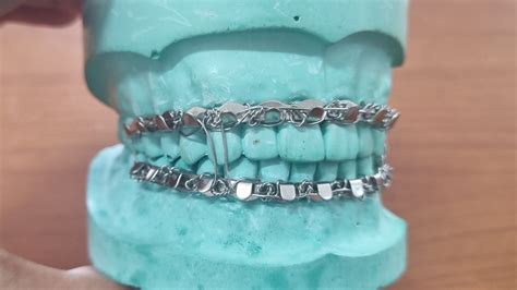 Erich Arch Bar Fixation Demonstration Oral Surgery Youtube
