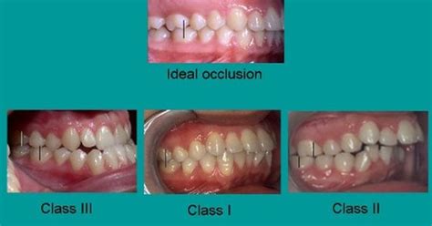Class Ii Div I Occlusion Venessa Mcnabb