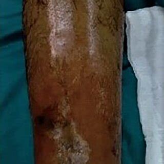 A And B Adult Male With Open Comminuted Shaft Femur Treated With Ring Download Scientific