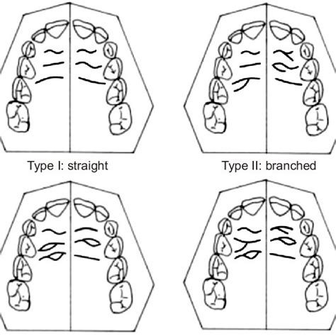 Classification Of The Types Of Palatal Rugae Pattern Based On The