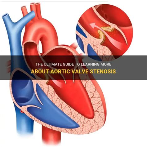 The Ultimate Guide To Learning More About Aortic Valve Stenosis MedShun