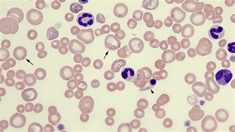 Siderocyte Archives Eclinpath