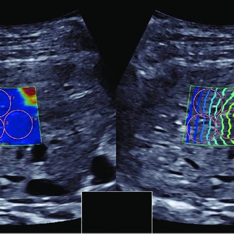 Two Dimensional Shear Wave Elastography Speed Mode On The Left And Download Scientific Diagram