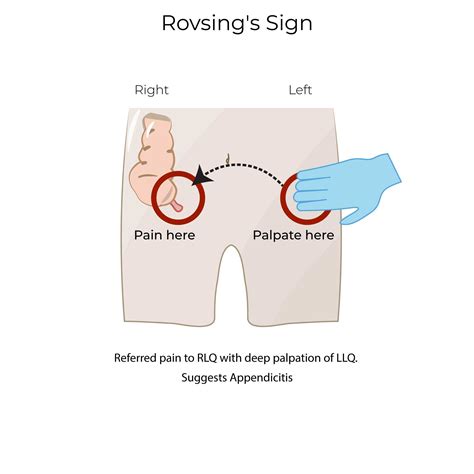 Clinical Pathology Glossary Rovsings Sign Ditki Medical