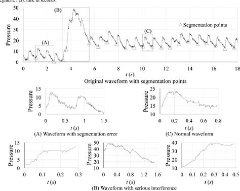 Figure 1 From Machine Learning Based Signal Quality Evaluation Of Single Period Radial Artery