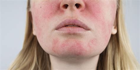 Rosacea Causes Symptoms And Effective Treatment Plans Rosacea Causes Symptoms And Effective Treatment Plans