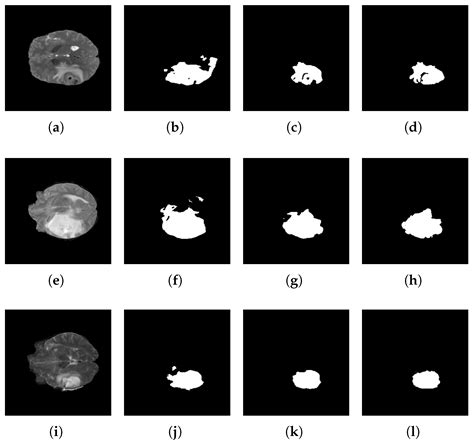 Brain Tumor Segmentation From Optimal Mri Slices Using A Lightweight U Net