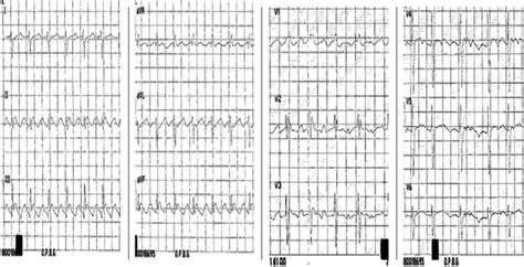 Atrial Flutter In Pediatric Patients Cardiac Electrophysiology Clinics
