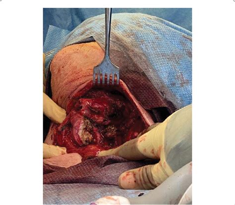 Anterior View Of Cervical Surgical Resection Site Download