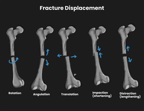 Introduction To Fractures Hyperexcision