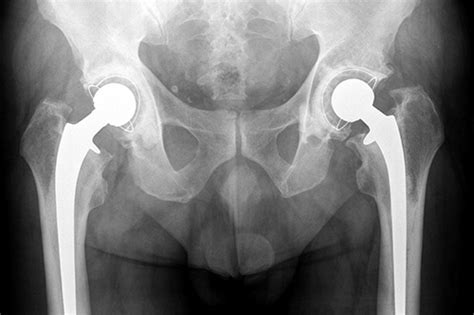 3d X Ray Dark Field Reconstruction Fau Erlangen Nürnberg