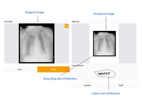 Github Sinharitesh App Pneumonia Detection Detect Pneumonia In Chest