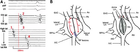 Conduction Block In Both The Lateral Wall And Cavotricuspid Isthmus In Download Scientific