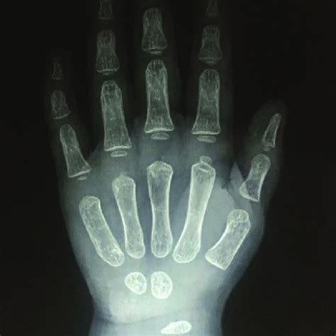 Bone Age 18 Months Is Less Than Chronological Age 36 Months In Case 2 Download Scientific