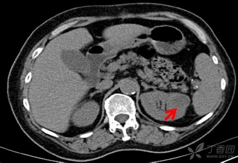 典型肾脓肿一例 丁香园