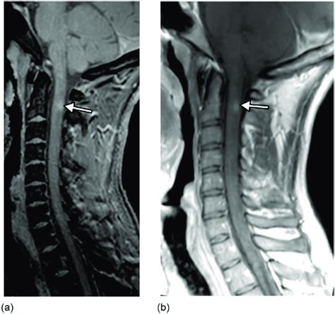 A 32 Year Old Man With Relapsing Remitting Multiple Sclerosis 3d Fast Download Scientific