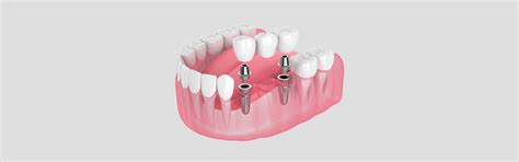 Guide To A Temporary Bridge Immediately After Tooth Extraction