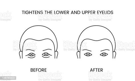 아래 눈꺼풀과 위 눈꺼풀 시술 전과 시술 라인 아이콘을 벡터에 도포 한 후에 레이저 미용을 조입니다 매끄럽고 깨끗한 피부와 주름을 가진 남자의 삽화 건강관리와 의술에 대한