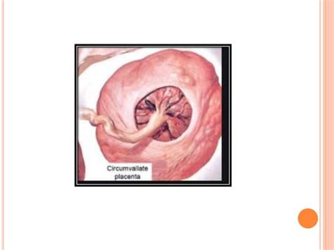 Abnormalities Of Placenta And Cord Pptx Pregnancy Reproductive Health