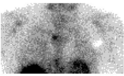 Figure 1 From Minimally Invasive Radio Guided Parathyroidectomy Semantic Scholar