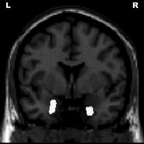 Voxel Based Morphometry Findings In Alzheimers Disease