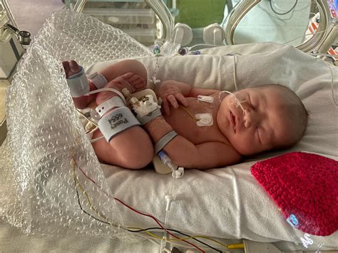 Ebsteins Anomaly Pulmonary Atresia Asd Vsd Raa Helena 1 Tiny