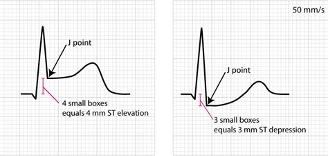 Figure 2 Examples Of Measuring St Segment Elevation And Depression