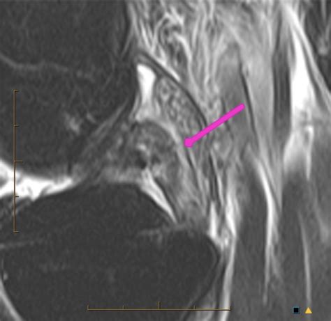 Posterior Cruciate Ligament Mri Tunnelless Anatomic Arthroscopic