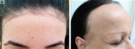 Normal Hairline Vs Receding Hairline Restoration Know All Your