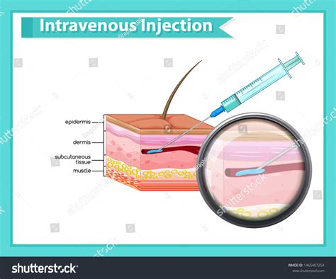 Scientific Medical Illustration Intravenous Injections Illustration เวกเตอรสตอก ปลอดคา