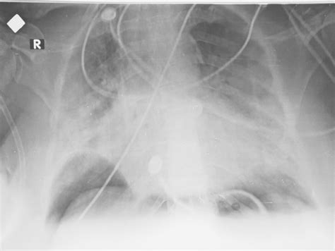 chest x‐ray showing bilateral circular inconspicuous heterogeneous