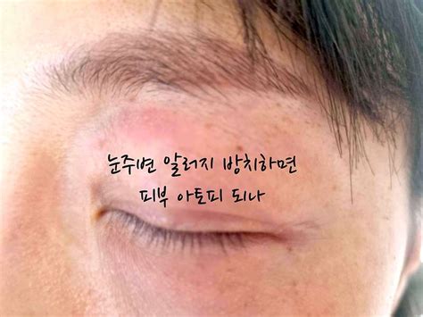눈주변 알러지 방치하면 피부 아토피 되나