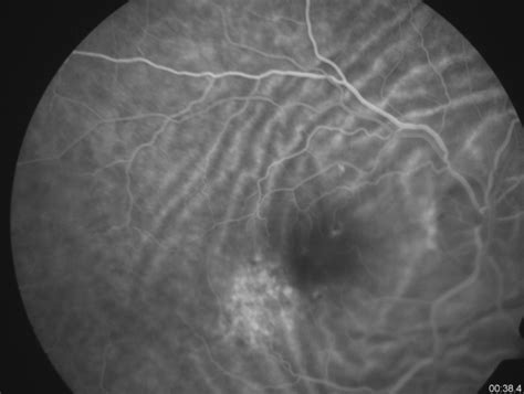Choroidal Folds Eyewiki